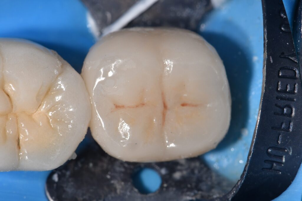 Preserving Tooth Structure in a Crown Preparation Design