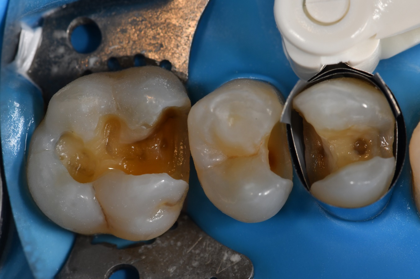 Matrix in Matrix used in quadrant biomimetic dentistry