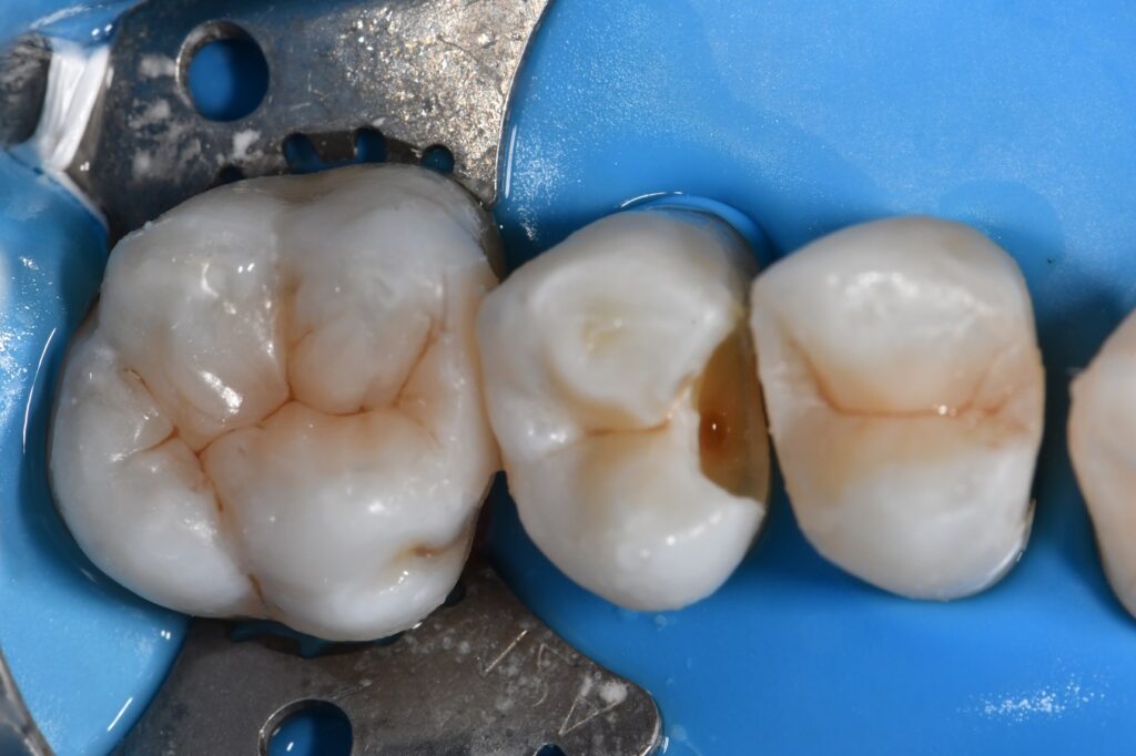 Matrix in Matrix used in quadrant biomimetic dentistry