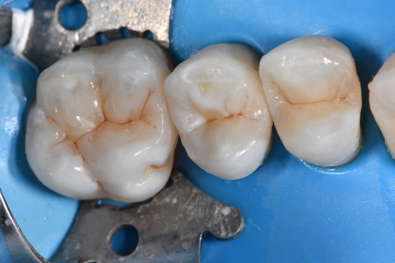Matrix in Matrix used in quadrant biomimetic dentistry