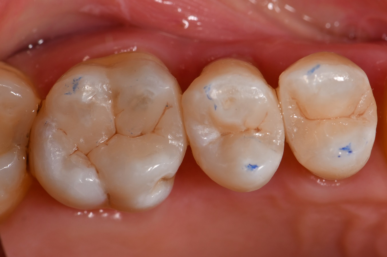 Matrix in Matrix used in quadrant biomimetic dentistry
