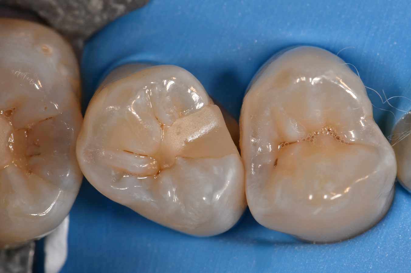 Tricks to restore a rotated tooth with composite