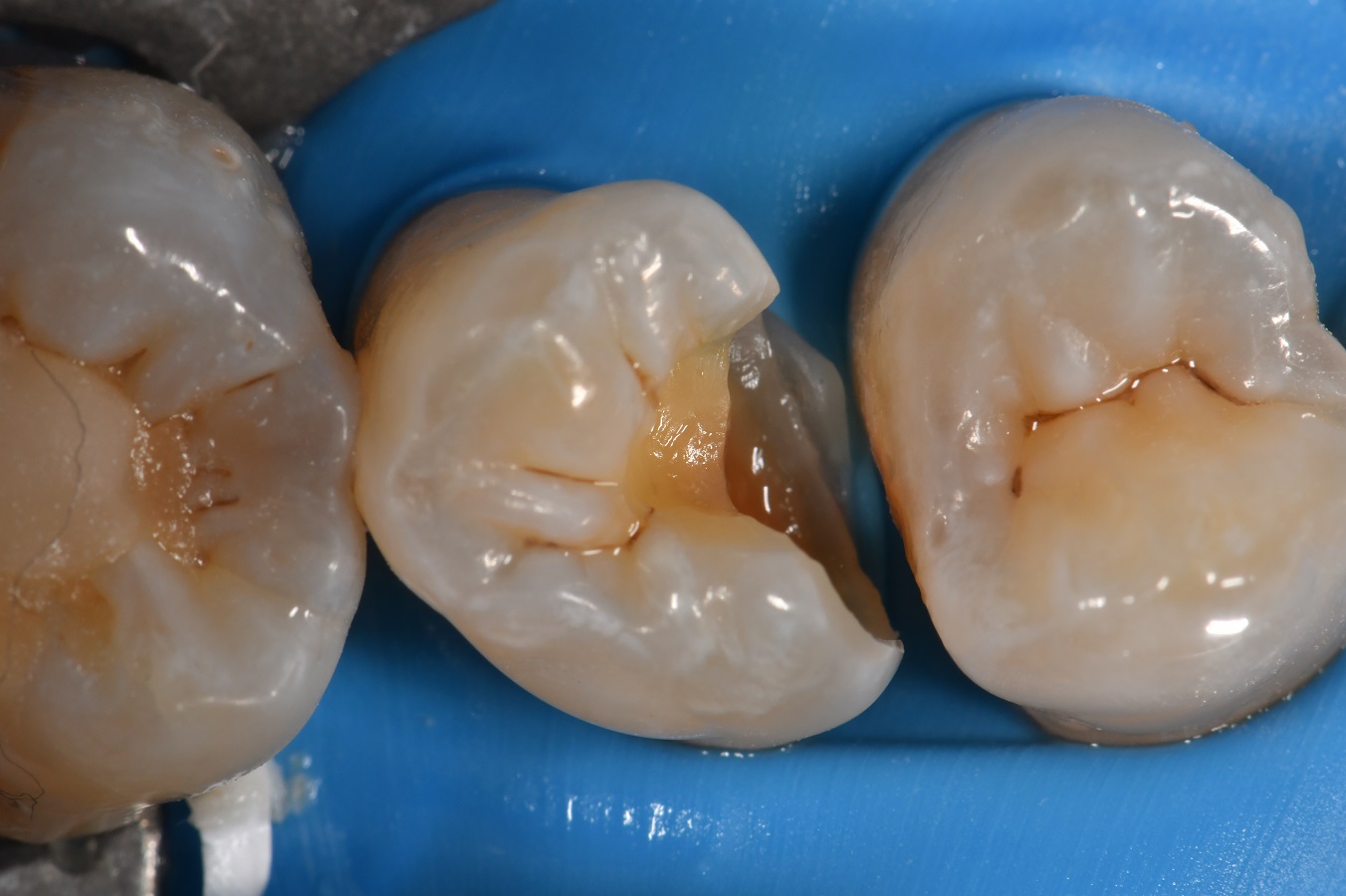 Tricks to restore a rotated tooth with composite