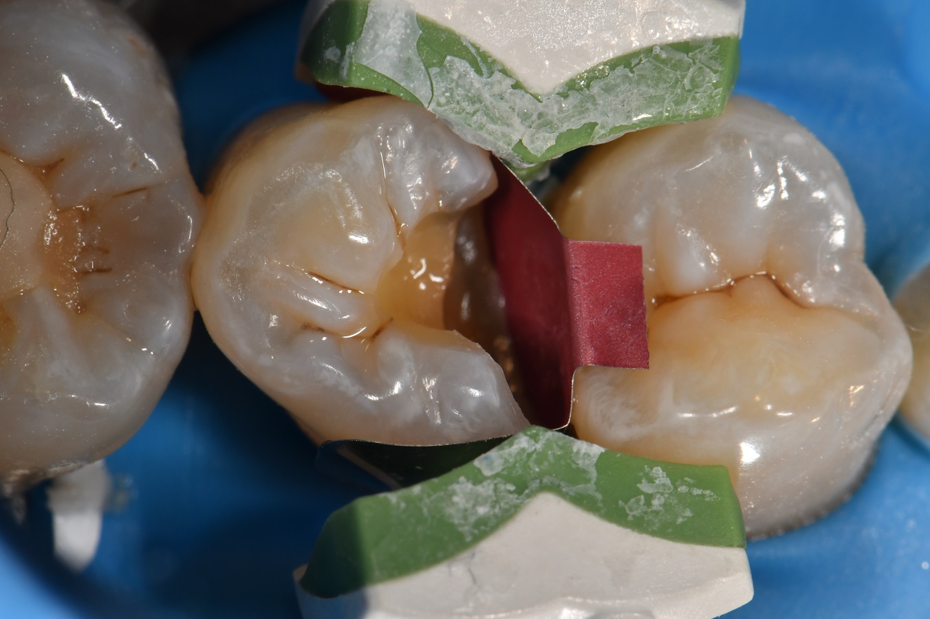Tricks to restore a rotated tooth with composite