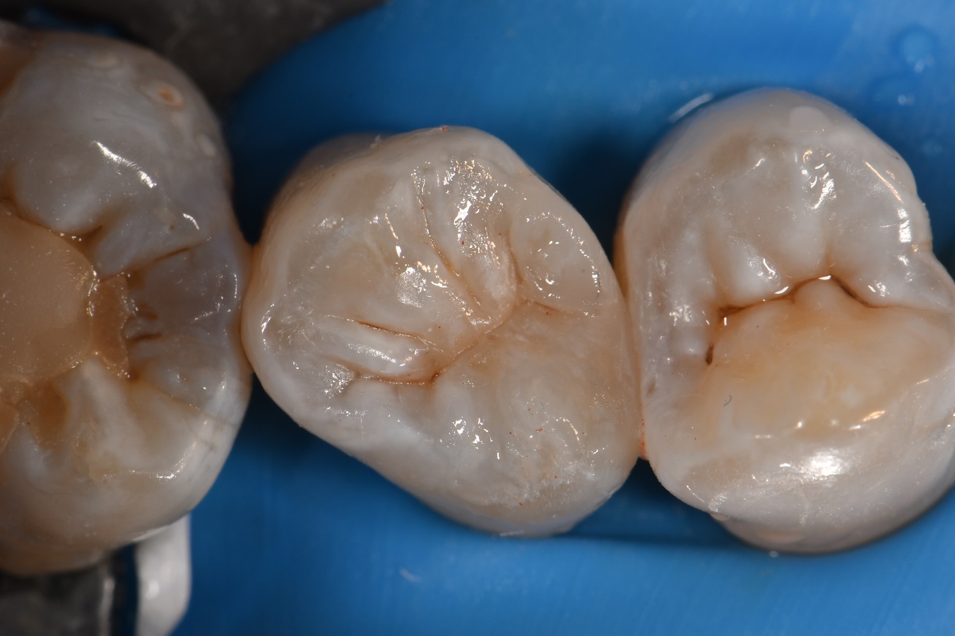 Tricks to restore a rotated tooth with composite