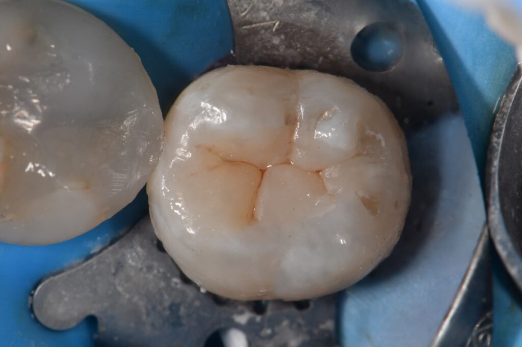 Reducing White Lines on Composite Restorations