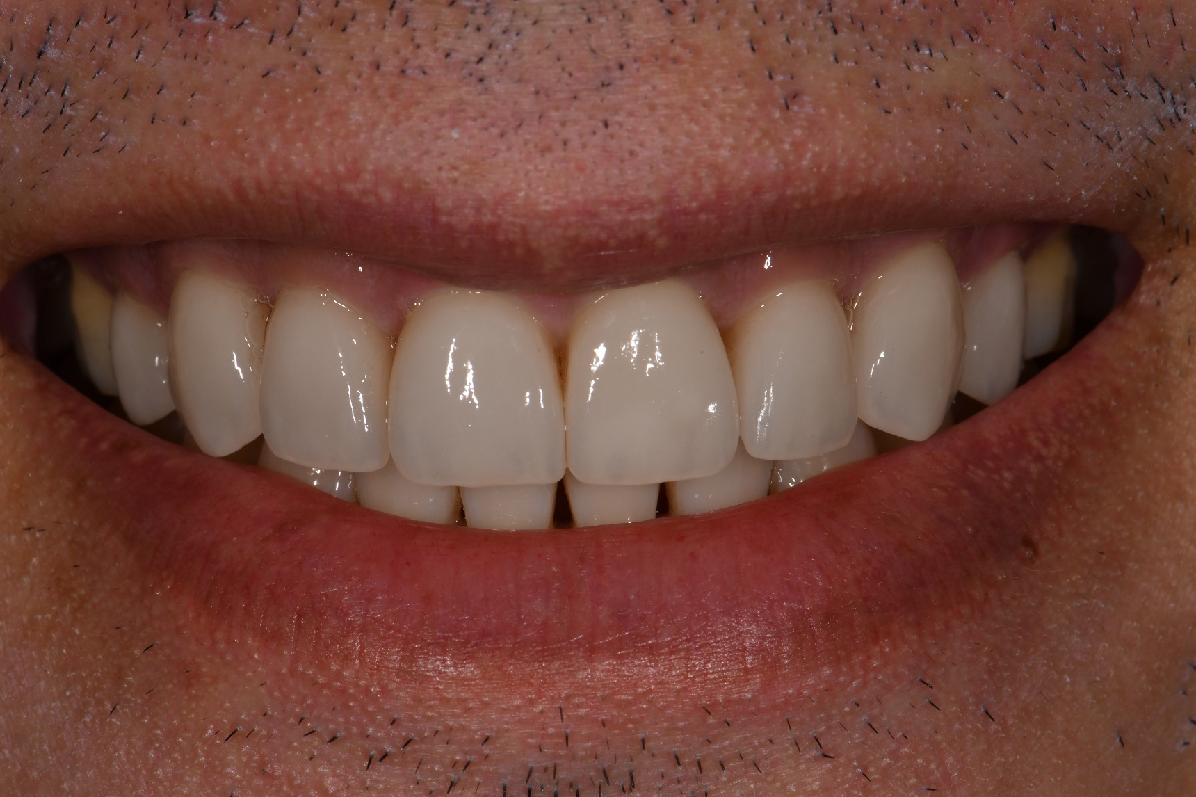 Smile Design that Changes The Personality of your Face