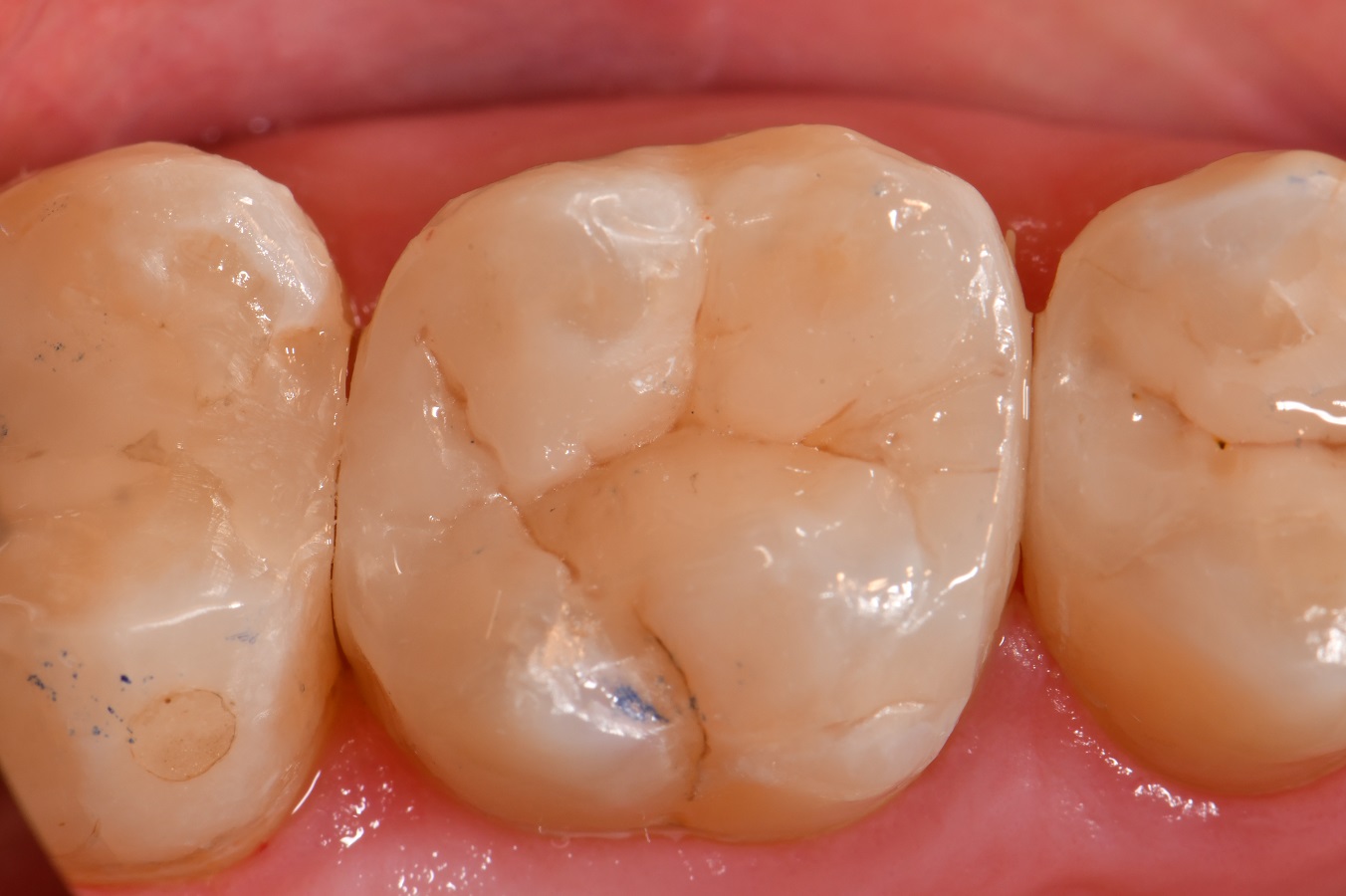 Voco Grandio SO Supercomposite in Action