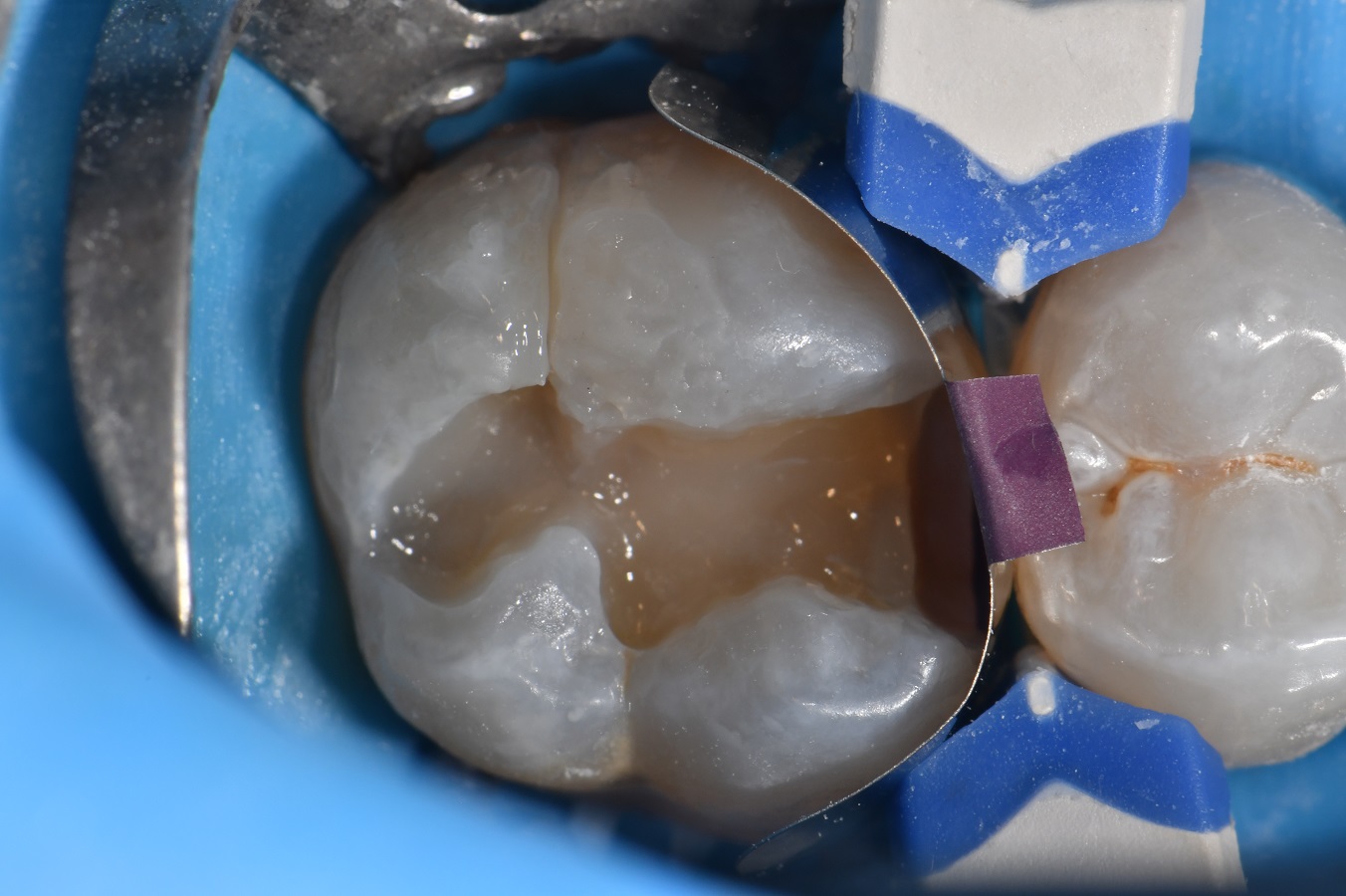 Sculpting natural fissures with composite resin