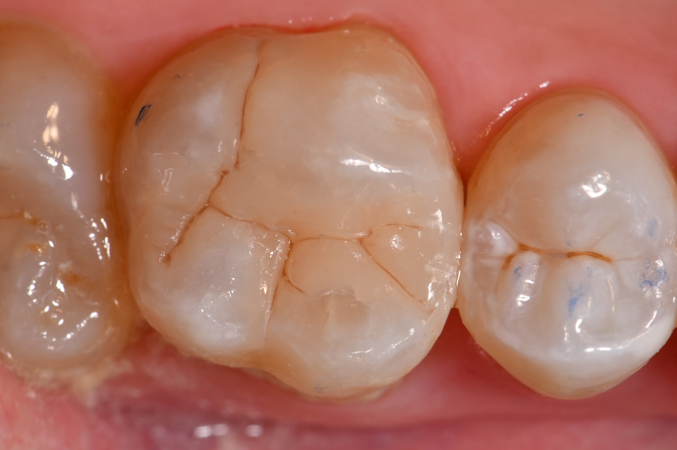 Sculpting natural fissures with composite resin
