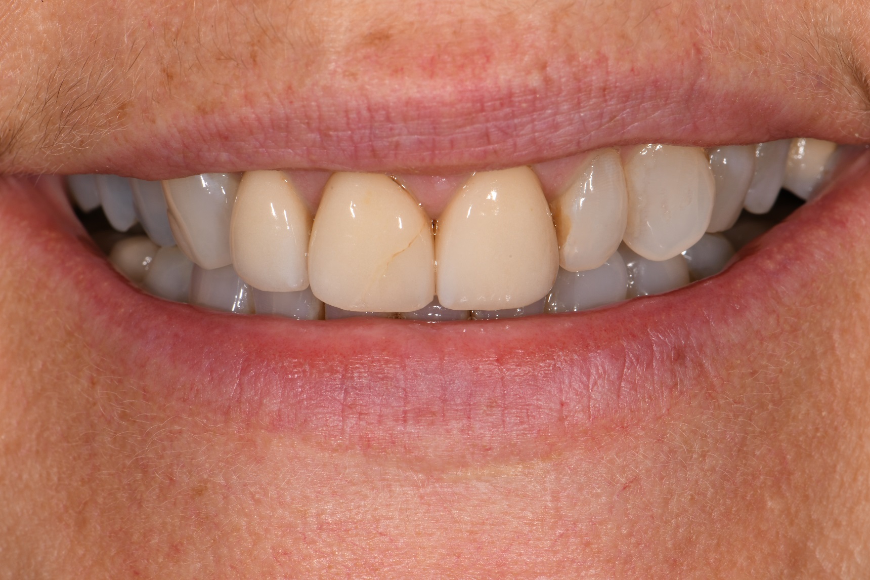 Bespoke Microlayered Porcelain Veneers Auckland