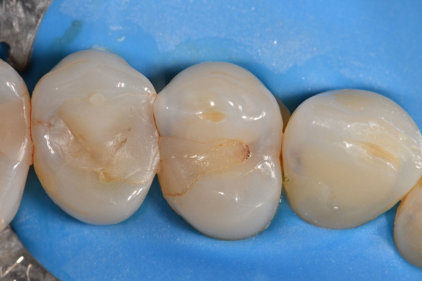 Direct composite MOD restoration Voco Grandio SO