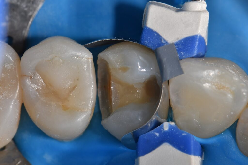 Direct composite MOD restoration Voco Grandio SO