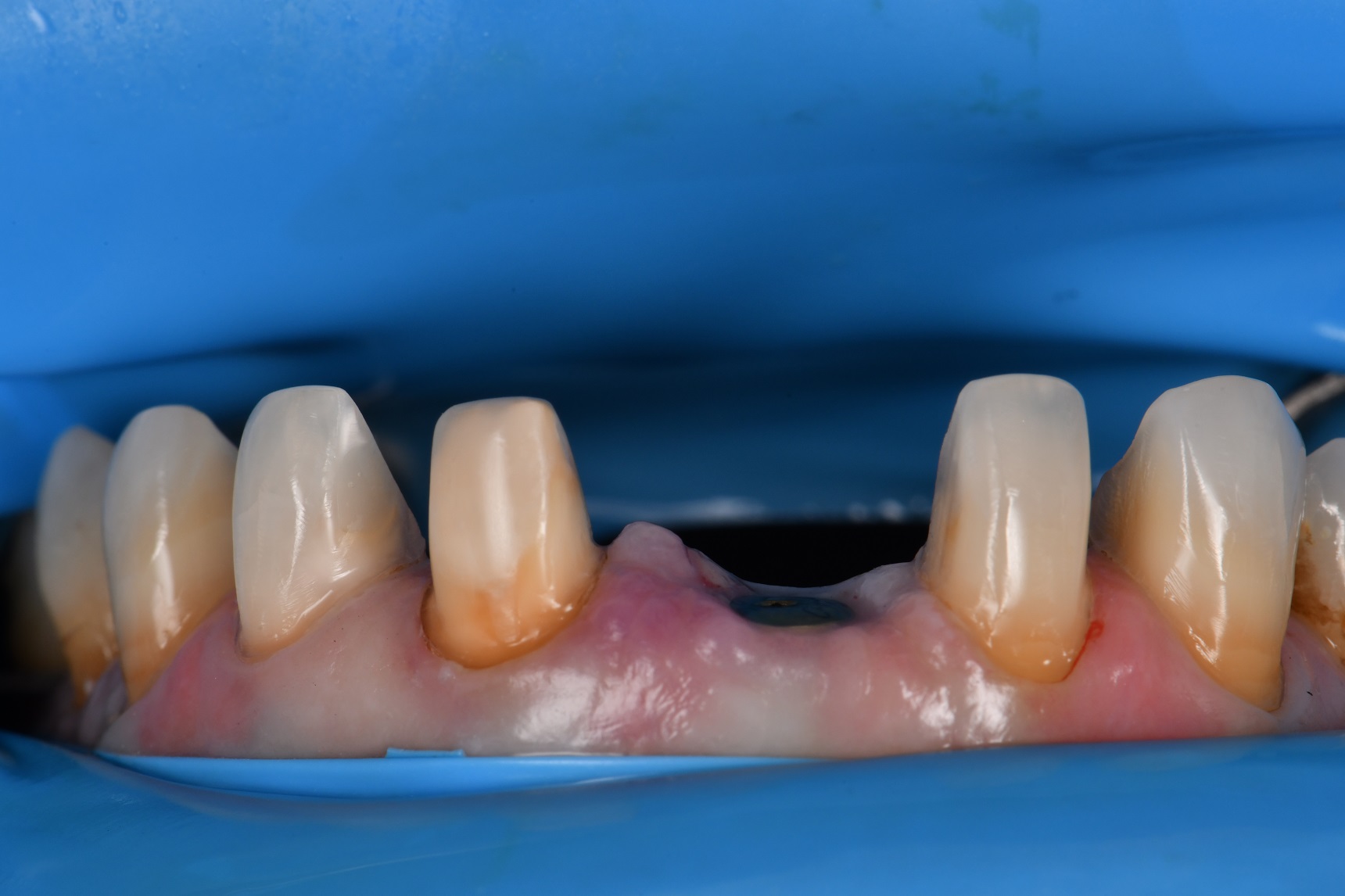 Indirect DSD-guided Smile Makeover Workflow