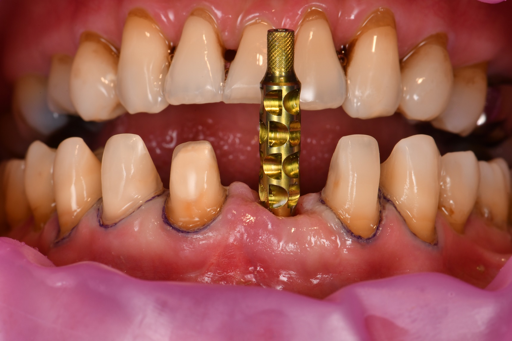 Indirect DSD-guided Smile Makeover Workflow