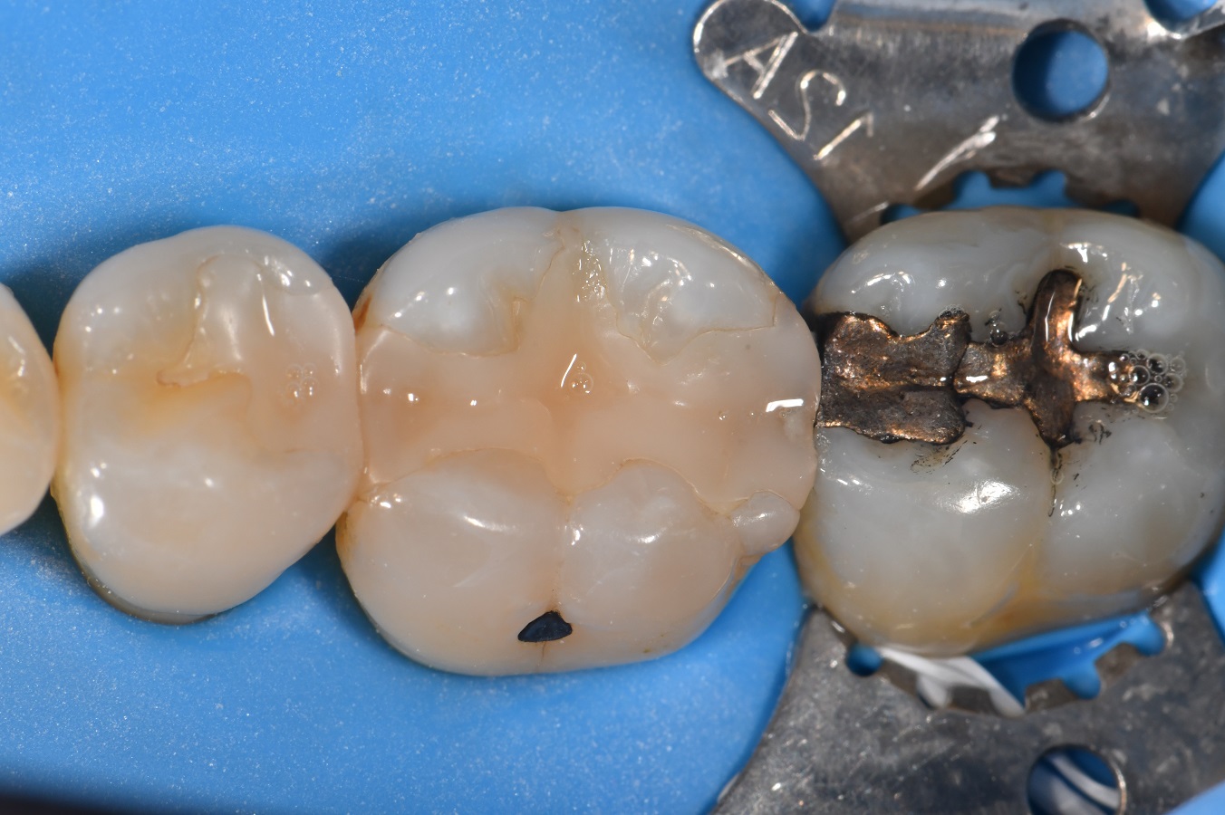 Complex carefully layered quadrant composite restorations
