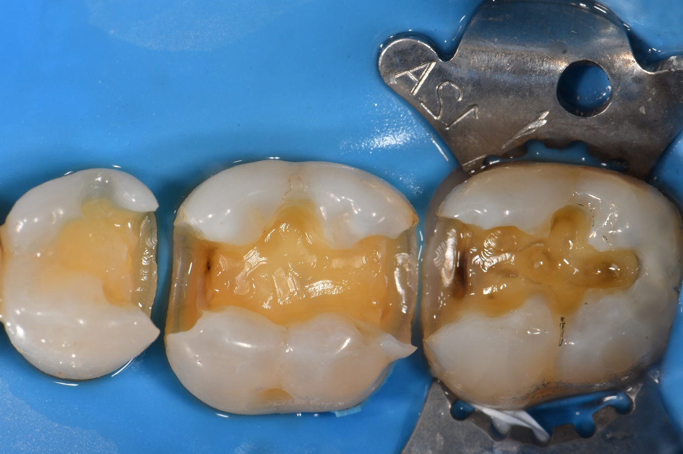 Complex carefully layered quadrant composite restorations