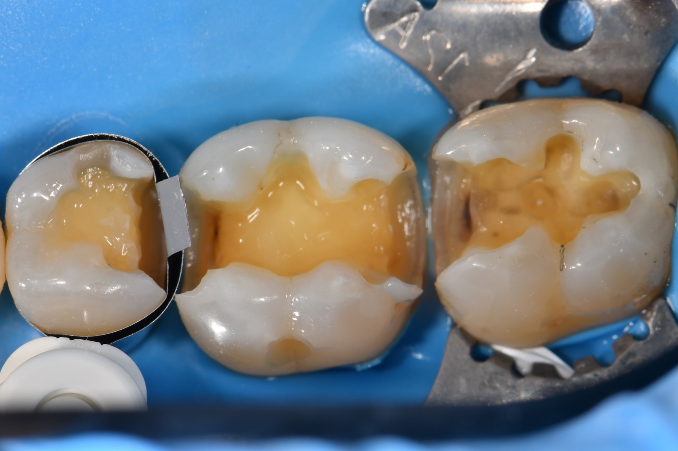 Complex carefully layered quadrant composite restorations