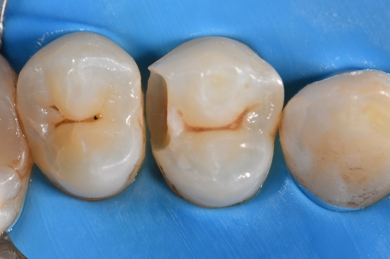 Slow Dentistry Class II restoration