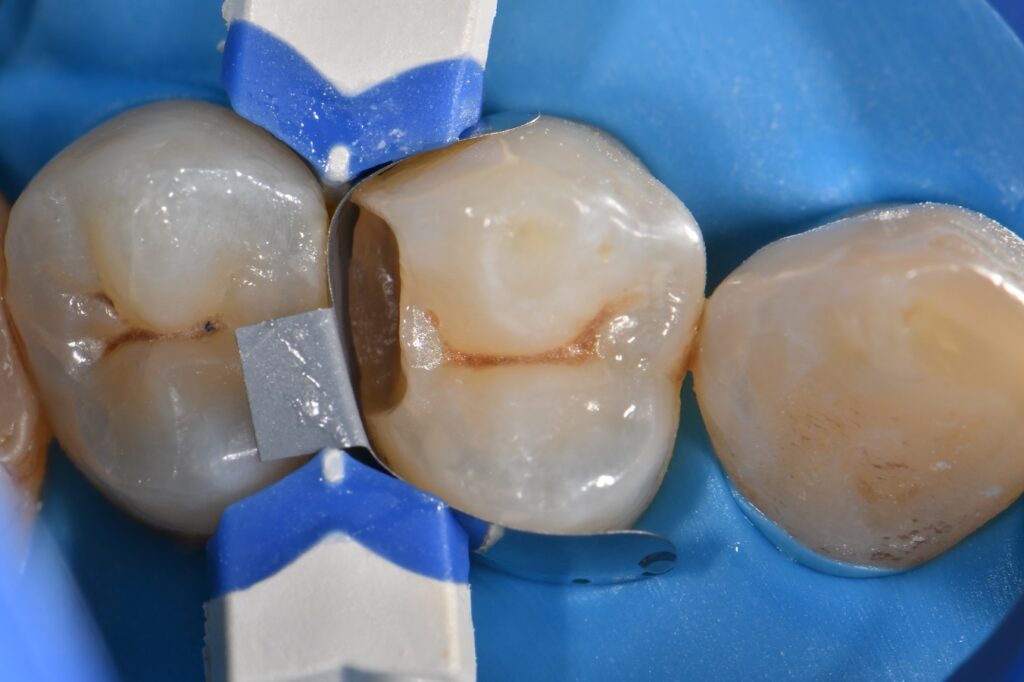 Slow Dentistry Class II restoration