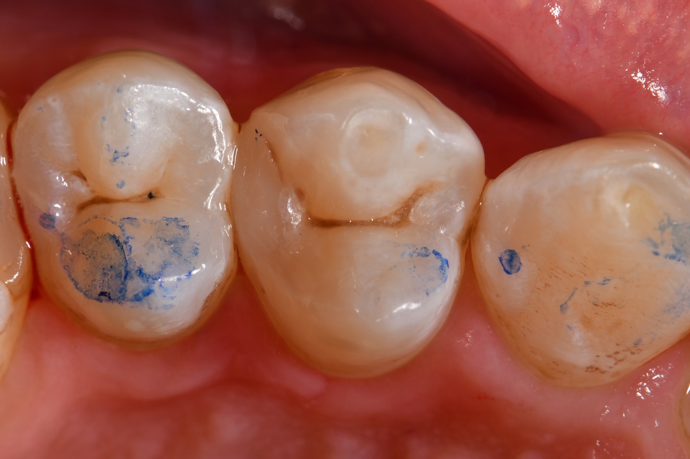 Slow Dentistry Class II restoration