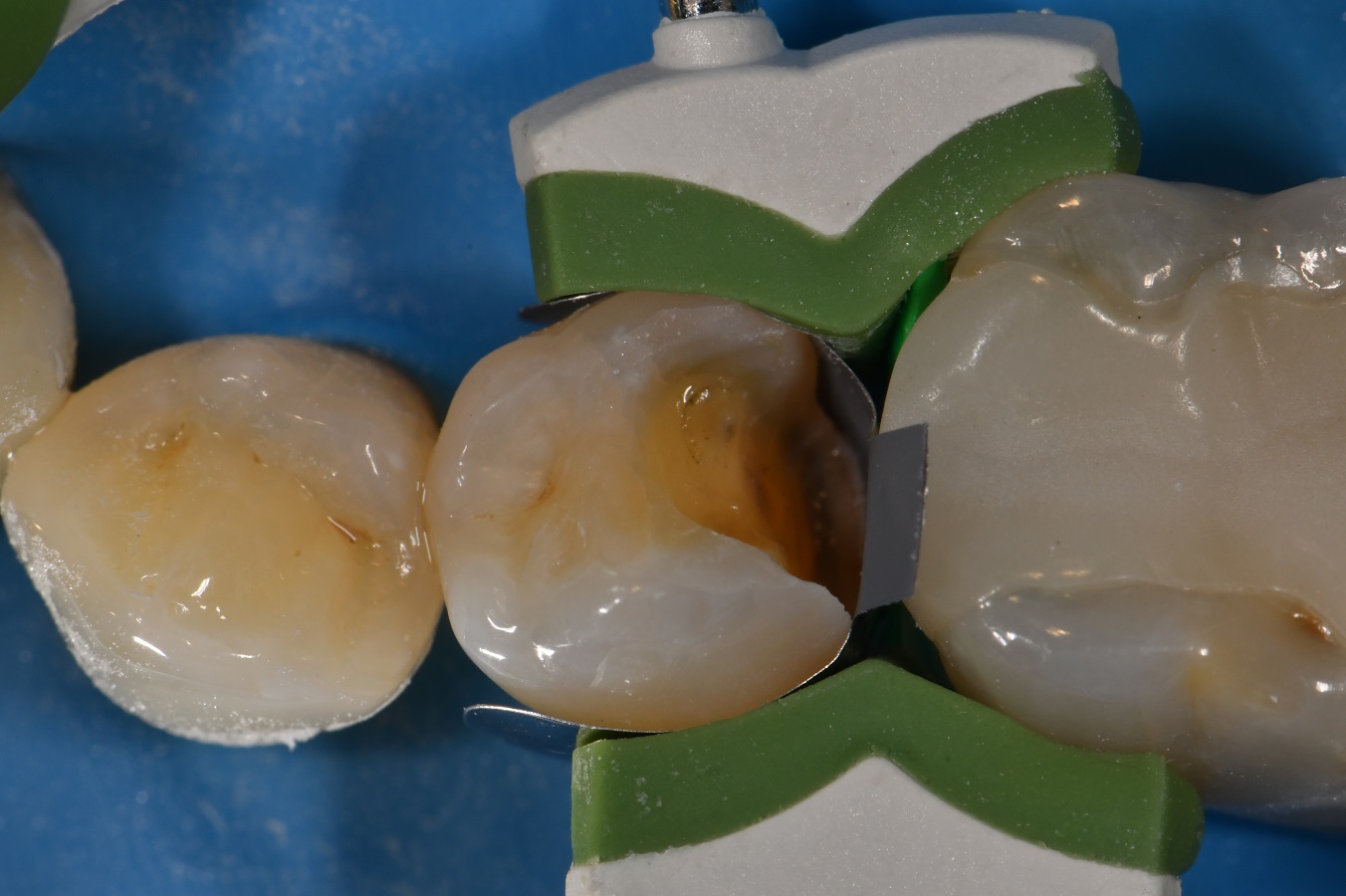 Garrison Wide Prep Ring with Voco Supercomposite