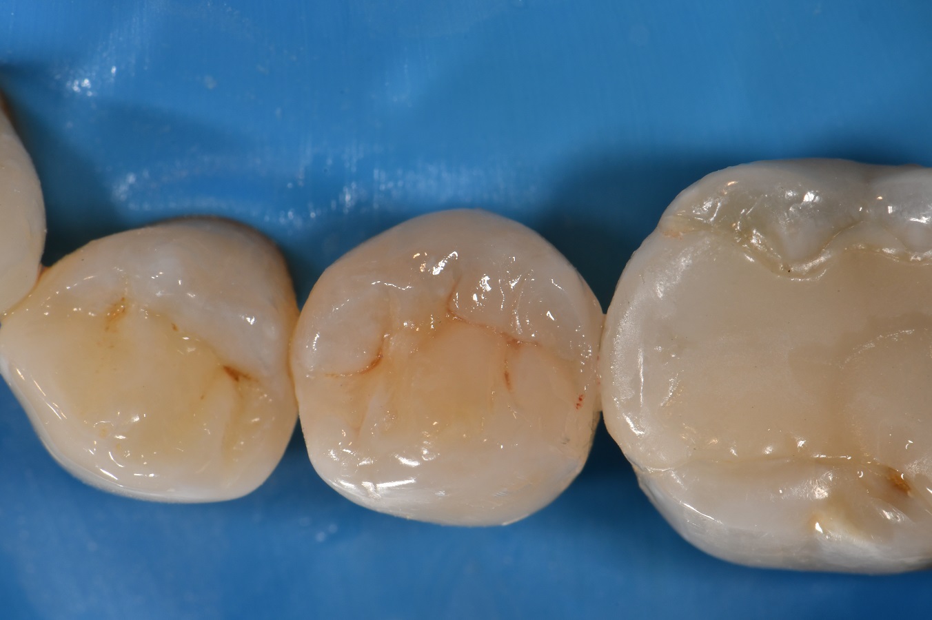 Garrison Wide Prep Ring with Voco Supercomposite