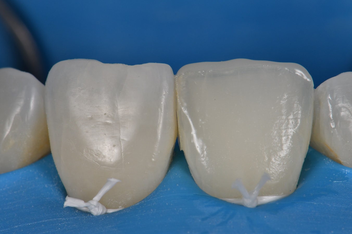 Layered Composite Partial Veneer with Voco Amaris
