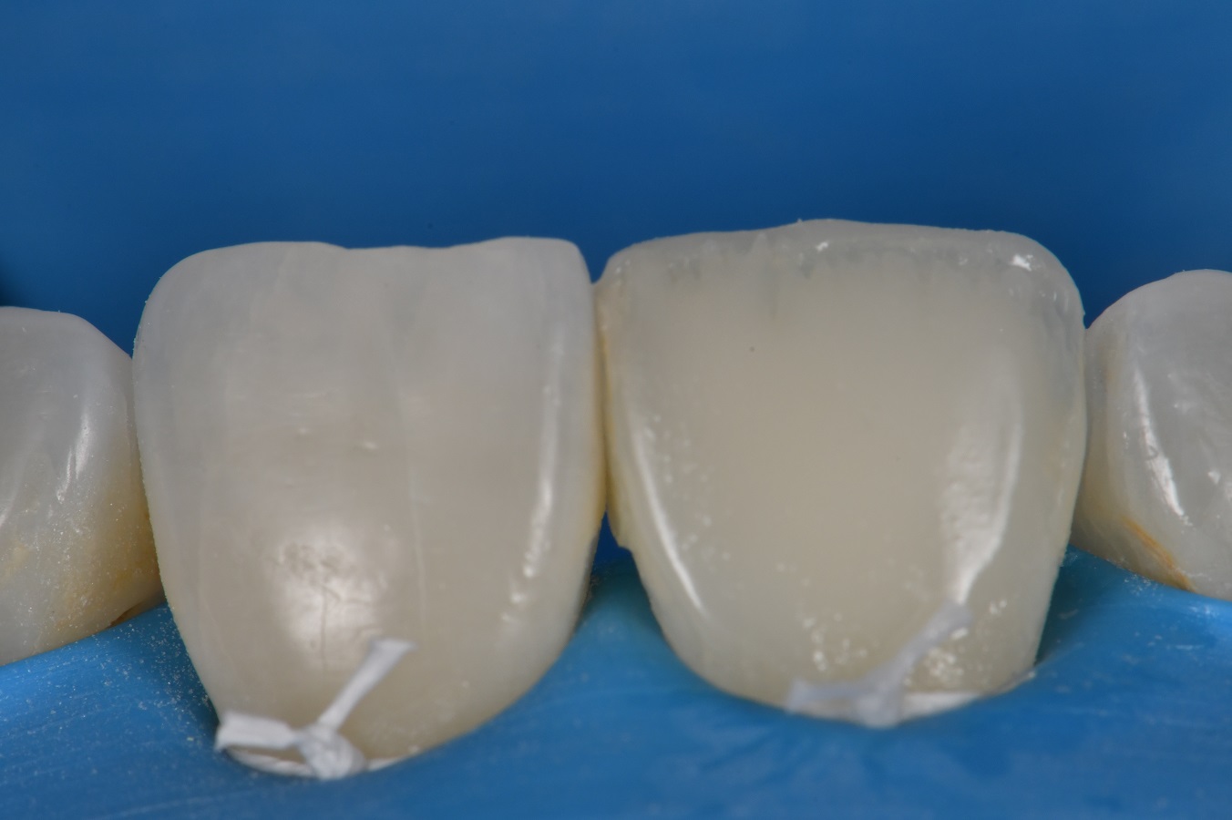 Layered Composite Partial Veneer with Voco Amaris
