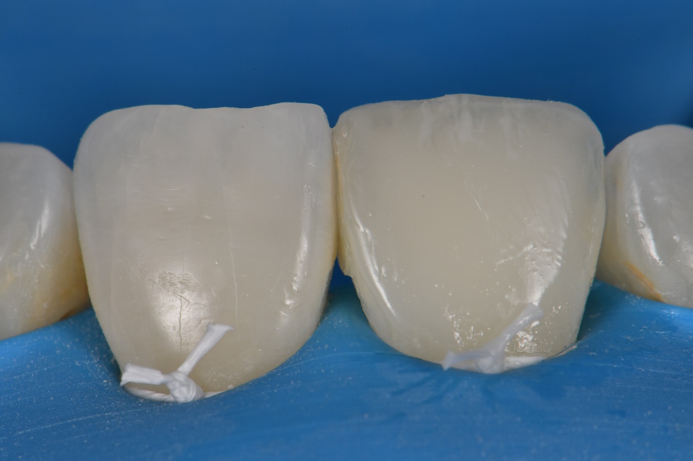 Layered Composite Partial Veneer with Voco Amaris