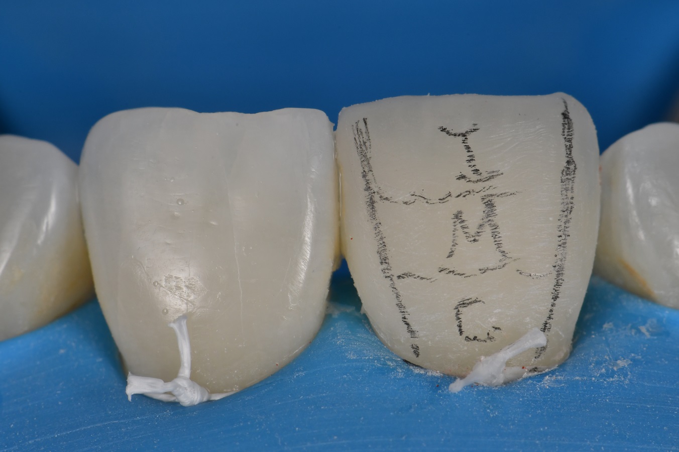 Layered Composite Partial Veneer with Voco Amaris