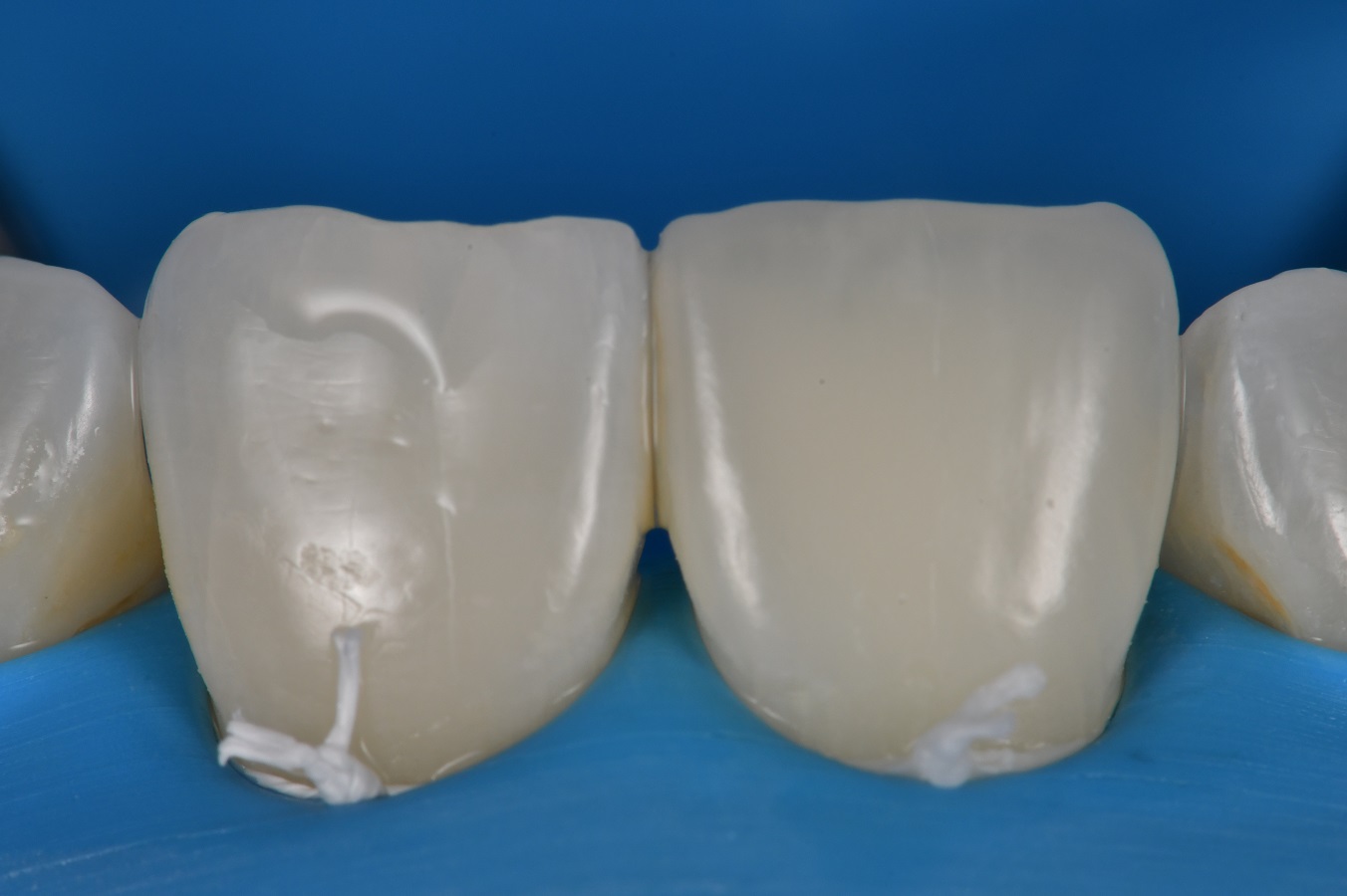 Layered Composite Partial Veneer with Voco Amaris