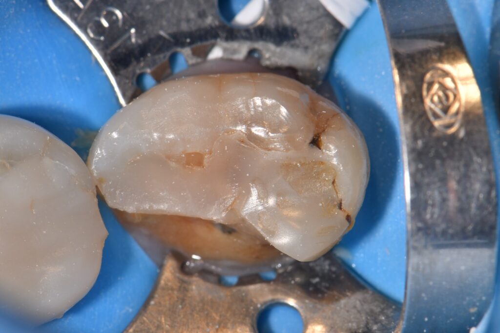 Conservative Crown for a Broken Down Molar