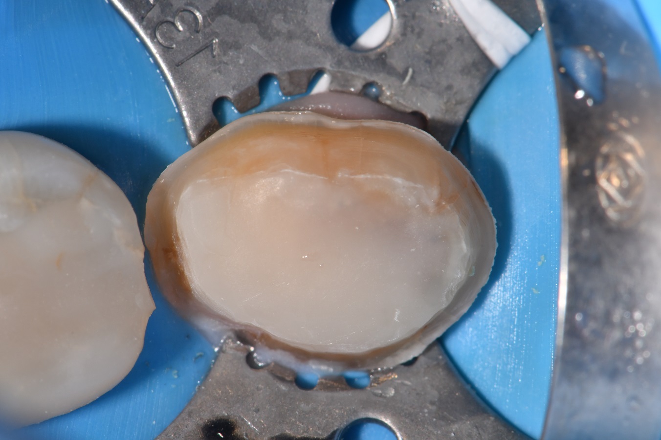 Conservative Crown for a Broken Down Molar