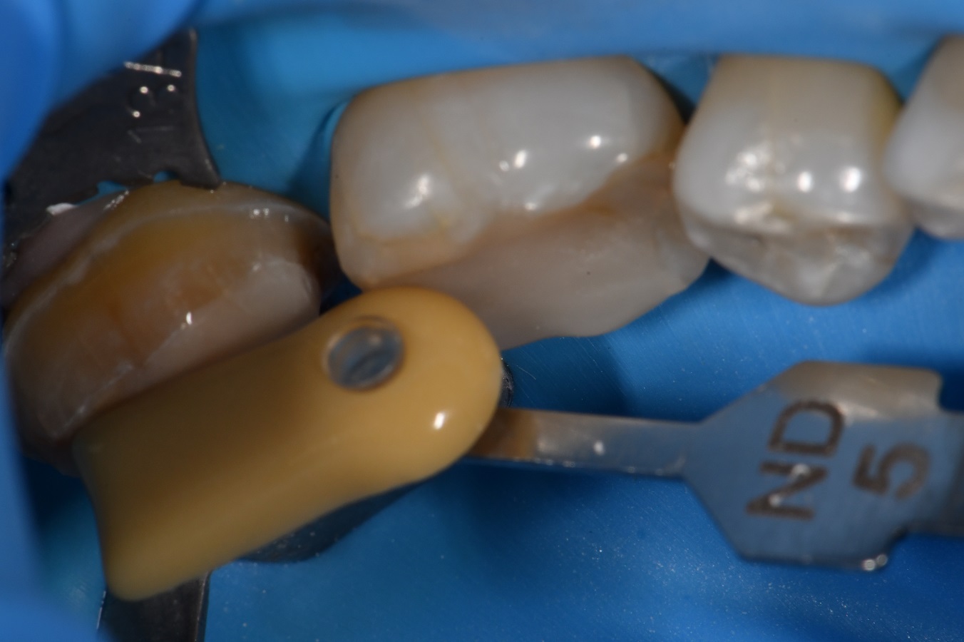 Conservative Crown for a Broken Down Molar
