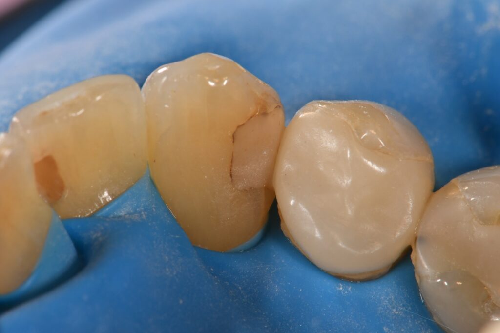 Class III supercomposite restoration