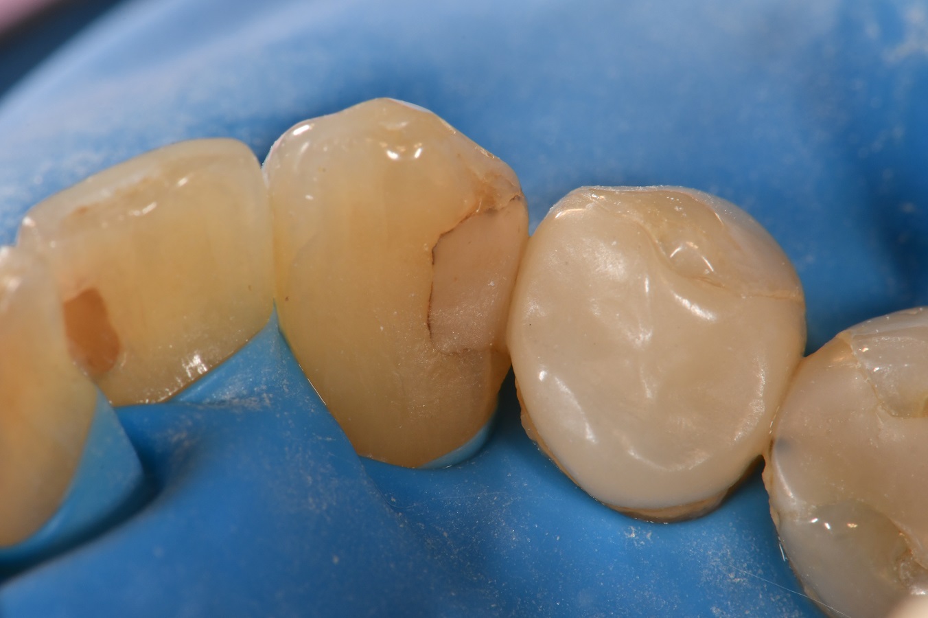 Class III supercomposite restoration