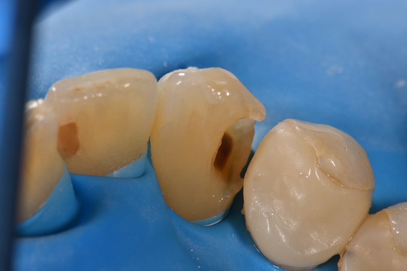 Class III supercomposite restoration