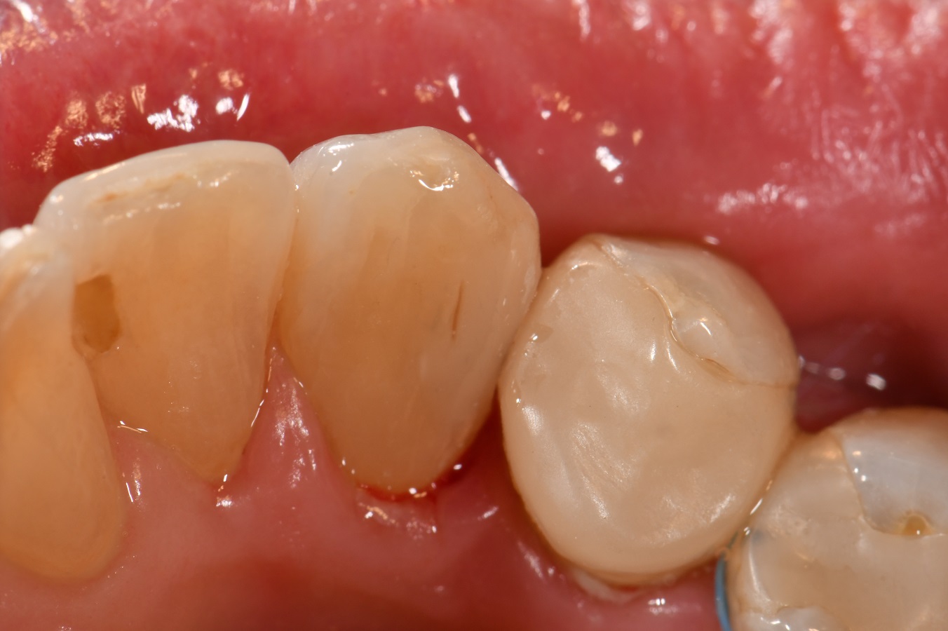 Class III supercomposite restoration