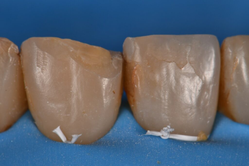 Voco Amaris Incisor Repair with Multiple Layers