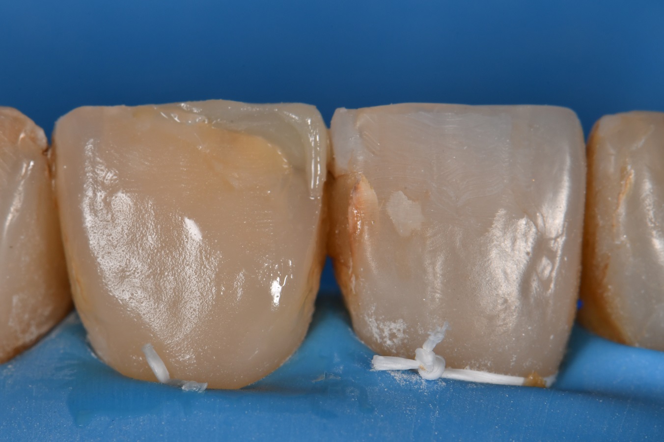 Voco Amaris Incisor Repair with Multiple Layers