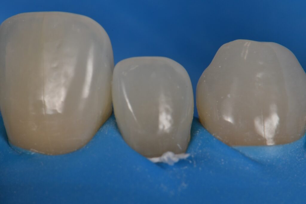 Generating translucency and window effects in a composite veneer