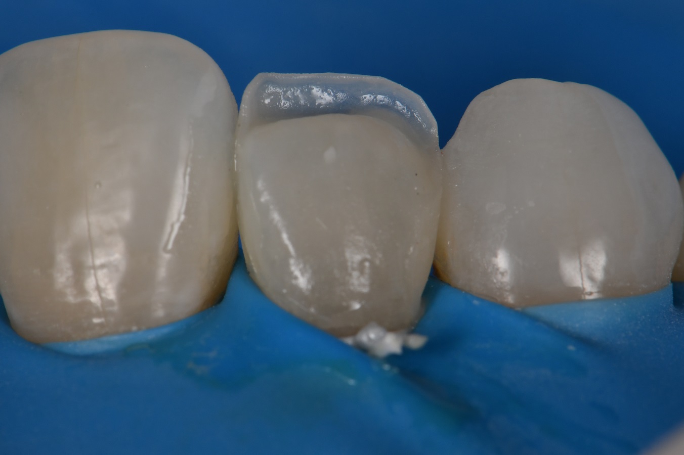 Generating translucency and window effects in a composite veneer