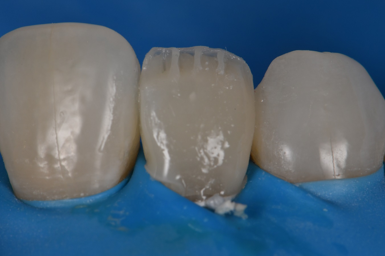 Generating translucency and window effects in a composite veneer