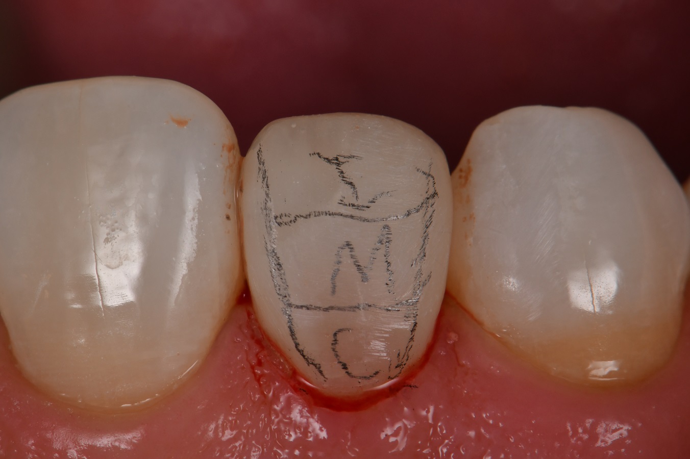 Generating translucency and window effects in a composite veneer