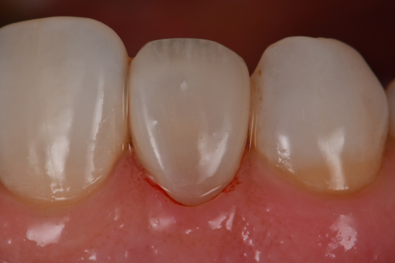 Generating translucency and window effects in a composite veneer