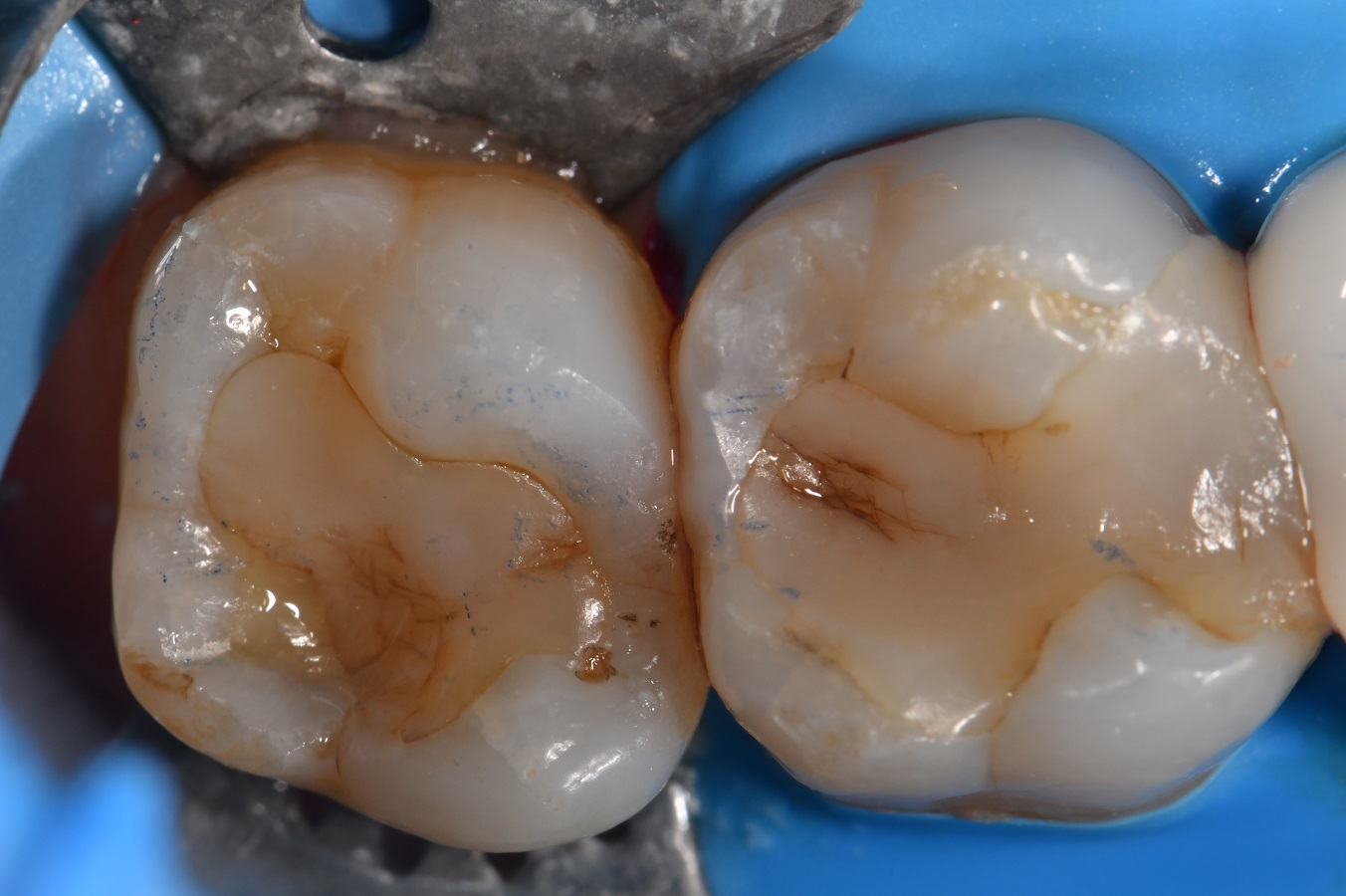 Simple back to back Class I and Class II direct restoration