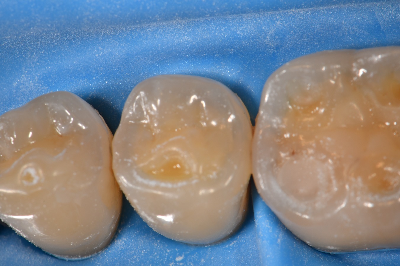 Slot Prep Precision Restoration