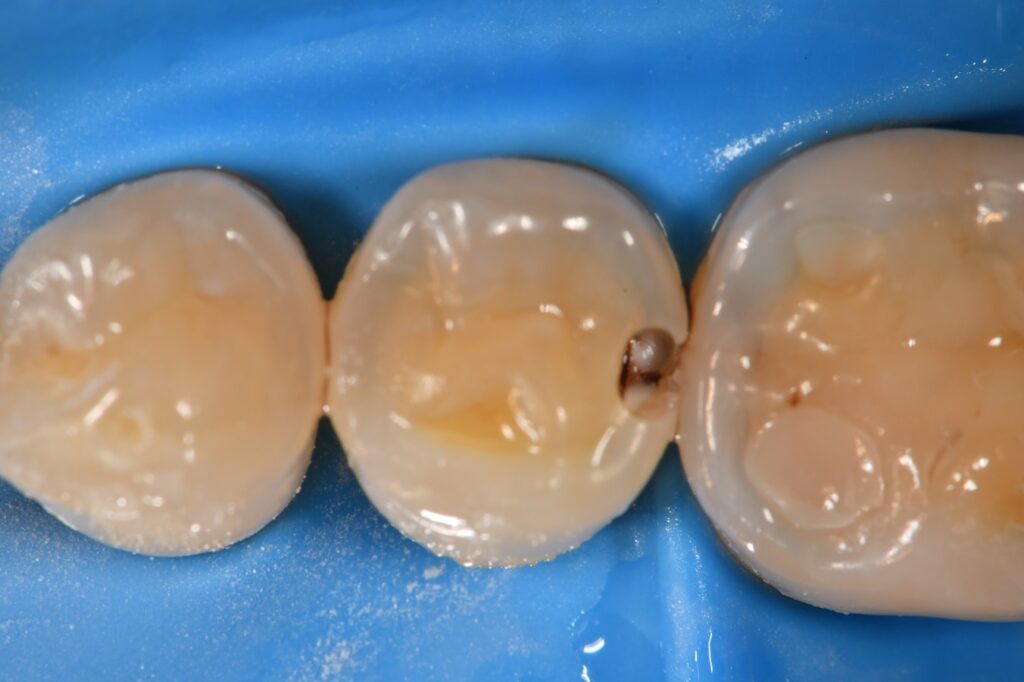 Slot Prep Precision Restoration