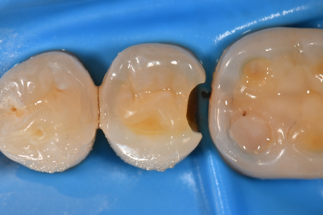 Slot Prep Precision Restoration